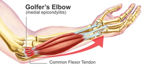 Golfer's Elbow; Nyeri Siku Bagian Dalam